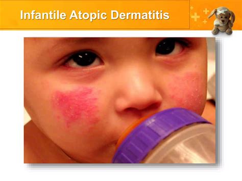 Common Pediatric Skin Rash Pptx