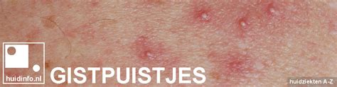 Jeukende Opgezette Tattoos