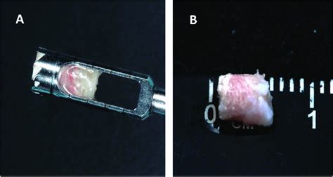 Operative Phase Ii A Bone Core Biopsy Collection Using A 4 Mm