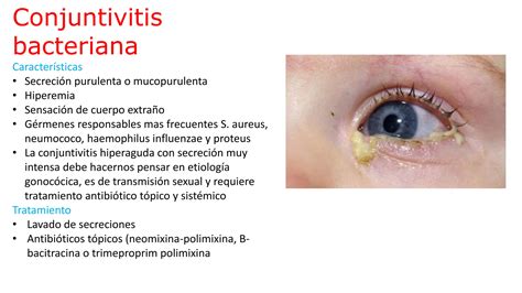 Conjuntivitis Pptx Eye And