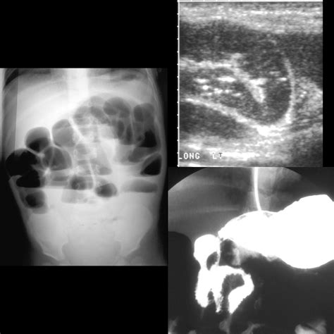 Malrotation With Midgut Volvulus Pediatric Radiology Reference Article Pediatric Imaging