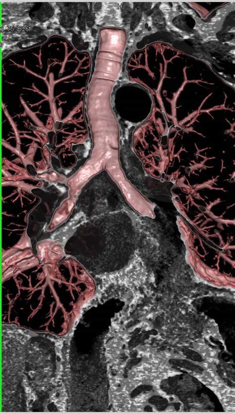Virtual Bronchoscopy Shows Non Small Cell Lung Cancer Occludes Left