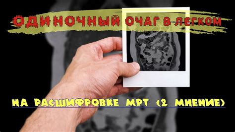 Одиночный ОЧАГ В ЛЕГКОМ и гепатомегалия печени на РАСШИФРОВКЕ МРТ брюшной полости второе мнение