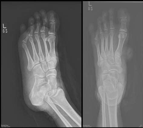 Empty Toe Phenomenon Eurorad