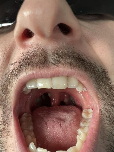 Weird Tissue On Uvula After Tonsillectomy Has Anyone Seen Anything