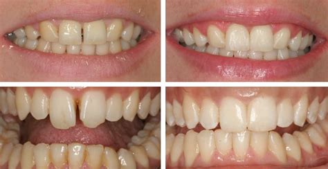 Spacers Missing Teeth
