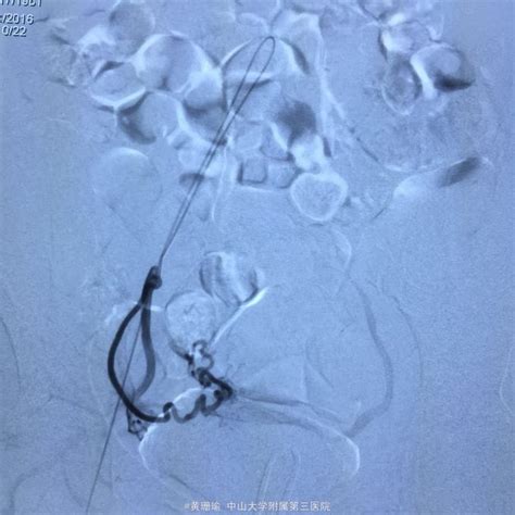子宫瘢痕妊娠药物流产大出血1例 医联