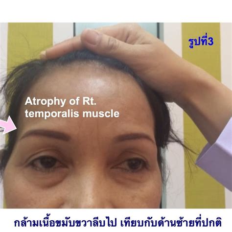 อาการปวดประสาทที่หน้า มาหาหมอมากมายค่ะ เราเรียกว่า Trigeminal Neuralgia Tn แปลกที่ทุกคนจะ