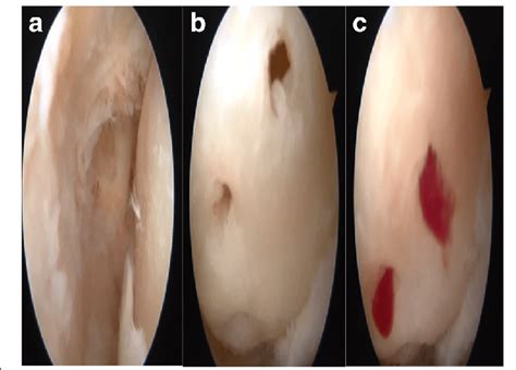 A Chondral Defect B Chondral Surface After The Microhole Drill C