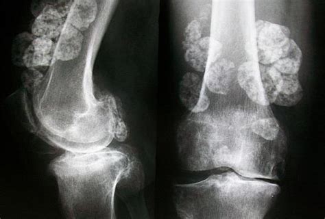 Synovial Chondromatosis Causes And Treatment Bone And Spine
