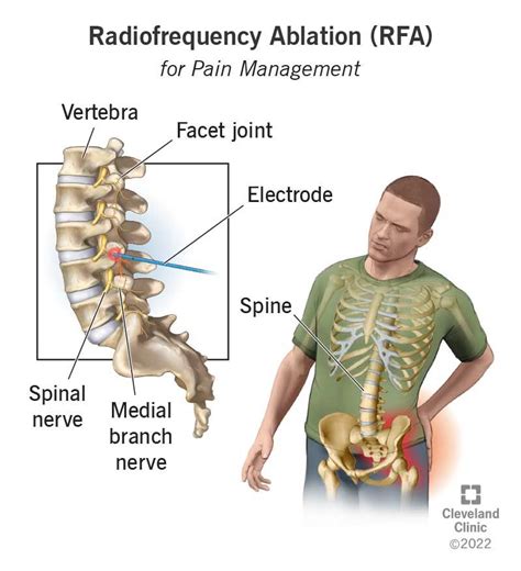 Radiofrequency Ablation Rfa What It Is Procedure Artofit