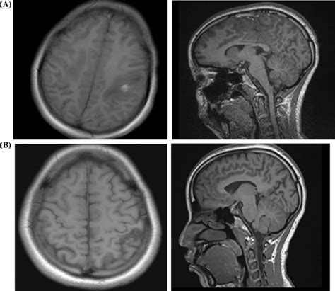 A Axial And Sagittal T1w Sequences Images Showing Focal Hyperintense