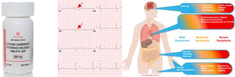 Lithium Toxicity Recapem