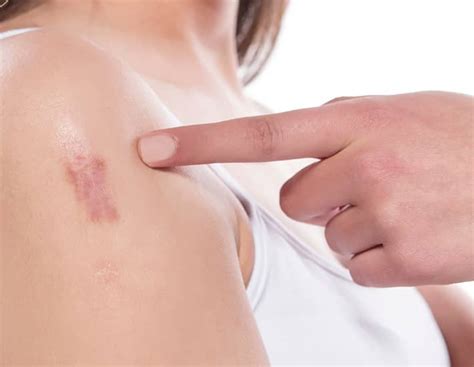 Unveiling The Truth About Keloid Scars Your Ultimate Resource