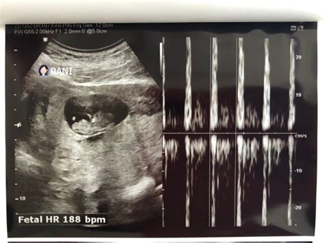 임신 9주차 증상 맘카페 입덧완화 젤리곰 초음파 분비물증가 네이버 블로그