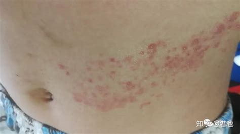 Hiv艾滋病皮疹 知乎