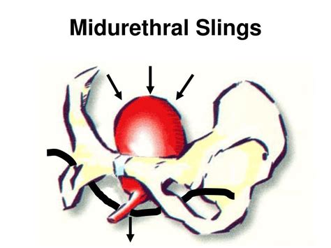 Ppt Overview Of Stress Urinary Incontinence And Minimally Invasive