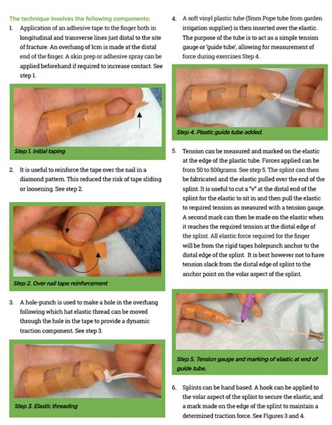 Distal Phalanx Fracture Splint