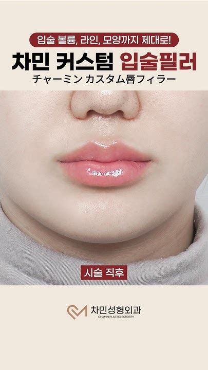 자연스럽게 혹은 화려하게 차민 커스텀 입술필러는 다 가능하니까 💋 입술필러후기 러시안립필러 필러시술 Youtube