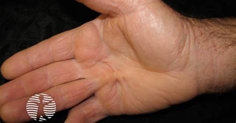 Dermnet® Dupuytren Contracture 01 Image