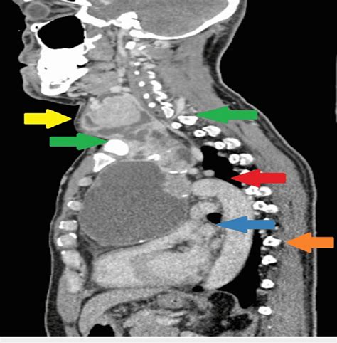 Ct Sagittal Plane Of The Goiter Extending Below Thoracic Inlet Into Download Scientific