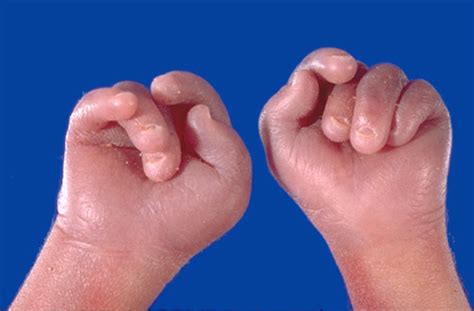 Pediatric Pathology