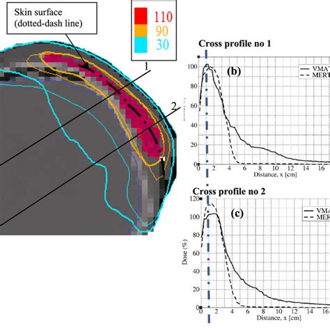 Comparison Of Isodose Distributions Between Vmat Thick Lines And Mert