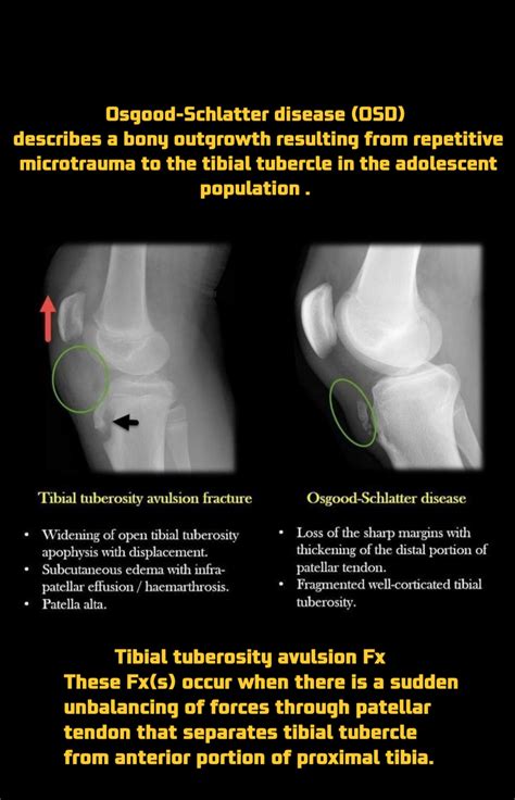 Tibial Tubercle Osgood Schlatter