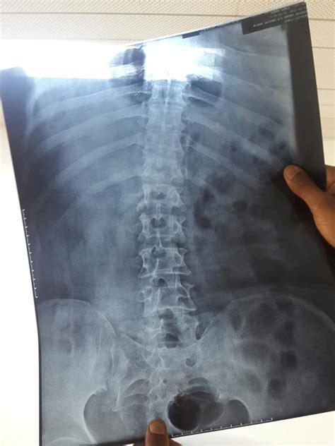 Pelvic Ring Fractures Trauma Orthobullets