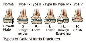 8b Pediatric Fractures Salter Harris Classification Flashcards Quizlet