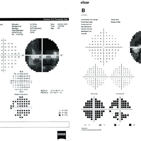 Image Depicting The Visual Field Printout Of Humphrey Field Analyzer