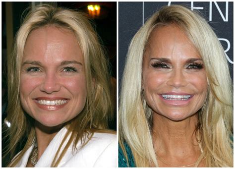 Did Kristin Chenoweth Get Plastic Surgery Experts Weigh In Exclusive