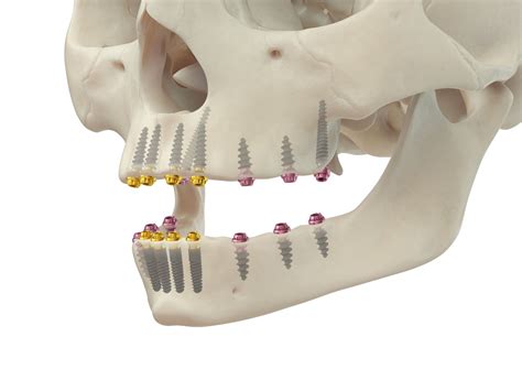 Roott M Pro Trate Implants Roott Roott M Pro Trate Implants Roott