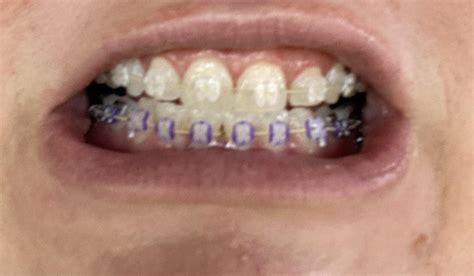 Day One Annnnnnd A Bracket Fell Off Braces