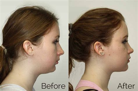 Difference Between Mouth Breathers And Nose Breathers At Teresa Stauffer Blog