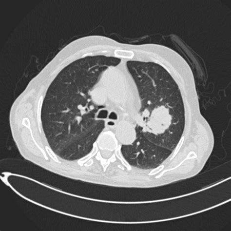 Download Brain Tumor Dataset Roboflow Universe