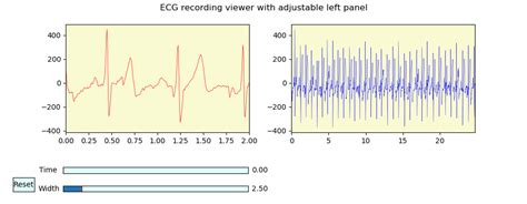 Pdf Video Demonstrating Functions Of Python Program Ecg Pyviewpy That Is Visualizing
