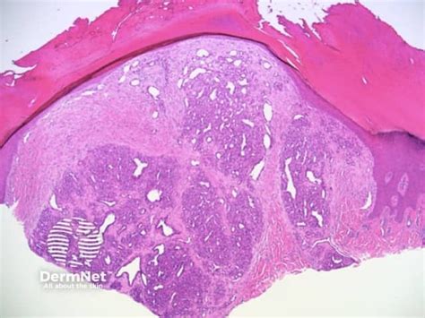 Oral Pyogenic Granuloma Histology Oral Pyogenic Granuloma—a Review
