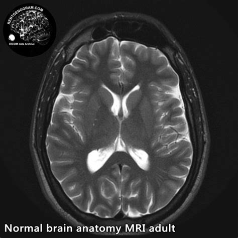 Dicom Normal Brain
