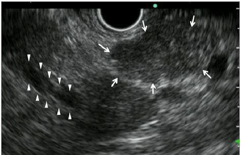 Endoscopic Us Shows A 28 Mm Low Echoic Mass Arrows And The Dilatation Download Scientific