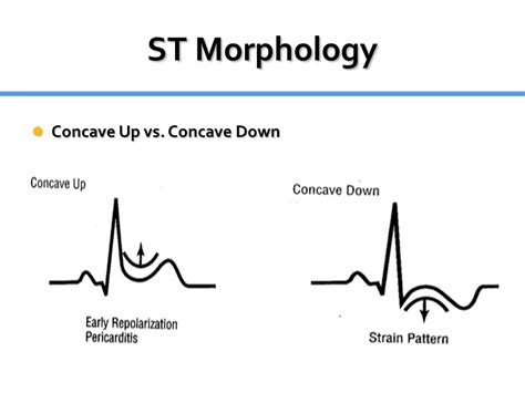 Concave Vs Convex Ecg Concave Vs Convex Ecg