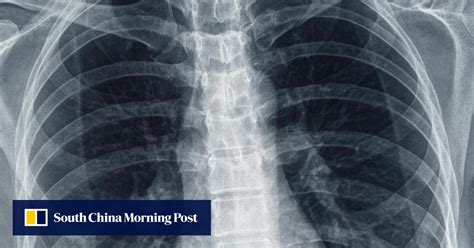 Doctors Missed Crucial Signs In Patients X Rays In Fatal Lung Cancer Blunder Hong Kong