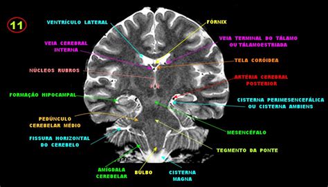Ressonancia Magnetica Do Hipotalamo Axial Neuro Protocolo Em