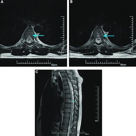 Axial Mri T2wi Sequence Showing High Signal Lesion In T7 Spinal Cord Download Scientific