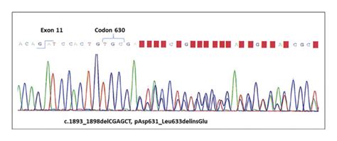 The Ret Germline Deletion In Exon 11 Of Our Patient A Sanger Download Scientific Diagram