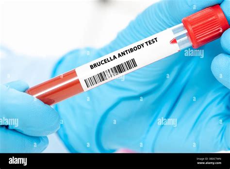 Brucella Antibody Test Detects Antibodies To Brucella Bacteria To Diagnose Brucellosis Stock