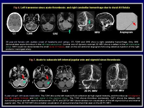 Usual And Unusual Imaging Findings And Pitfalls In