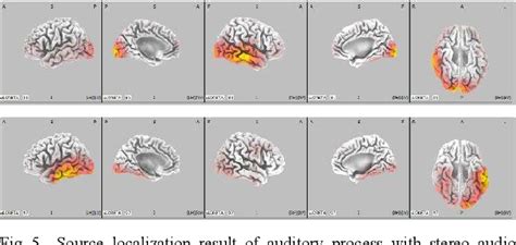 Figure 5 From Quantitative Eeg Analysis Based On Psd And Eloreta Source Localization Approach In
