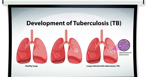 Health Understanding Tuberculosis New Straits Times