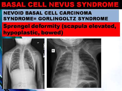 Basal Cell Nevus Syndrome Radiology Classroom